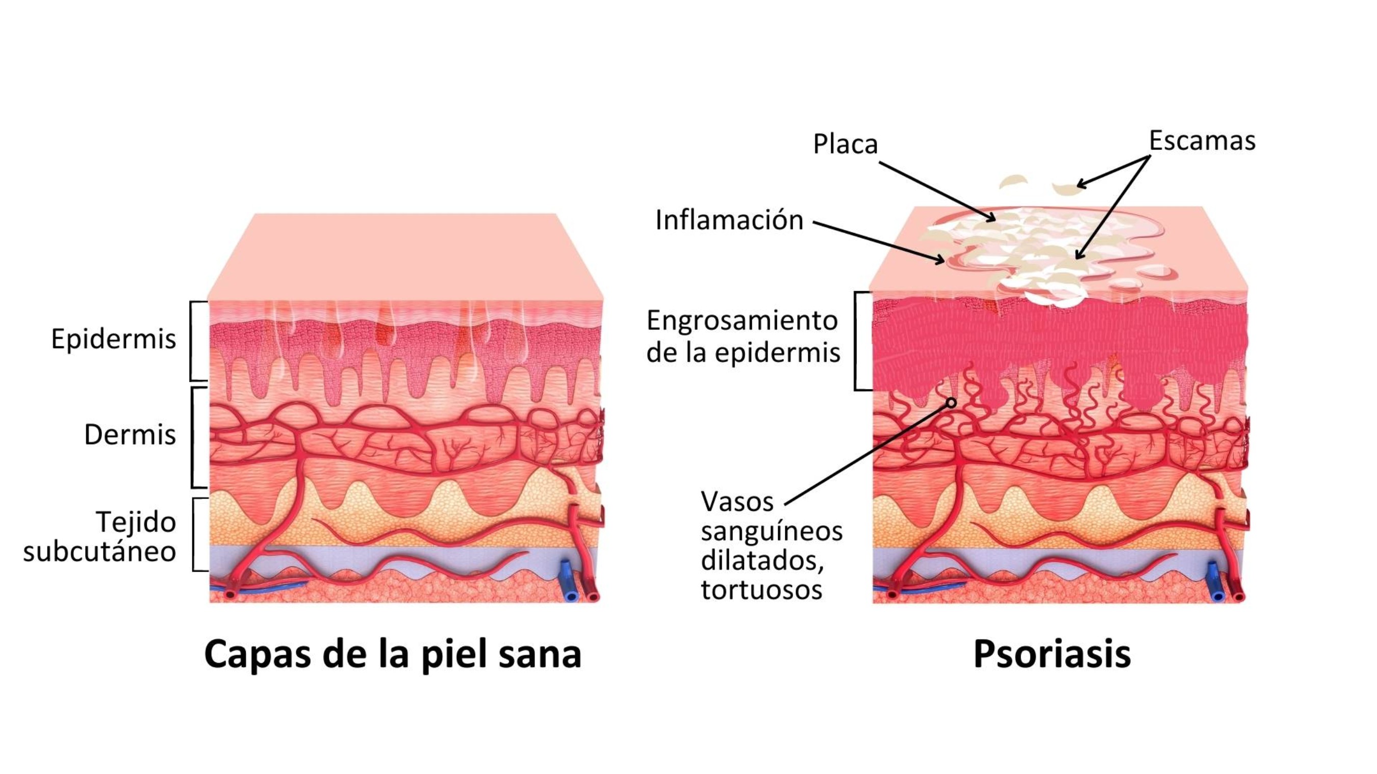 Qué Es La Psoriasis